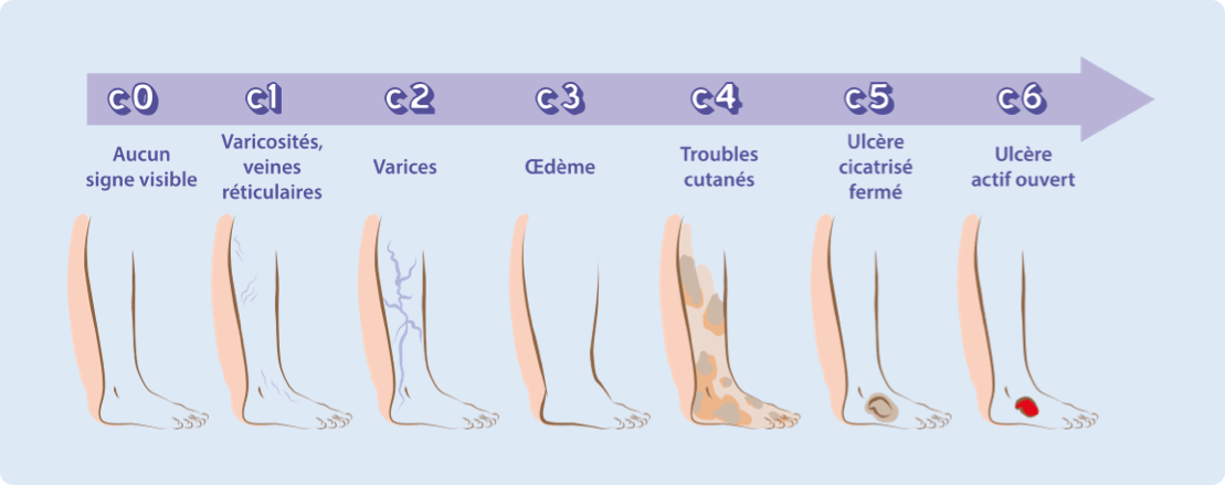 Insuffisance veineuse: quels sont les symptômes? | Chroniques de veines